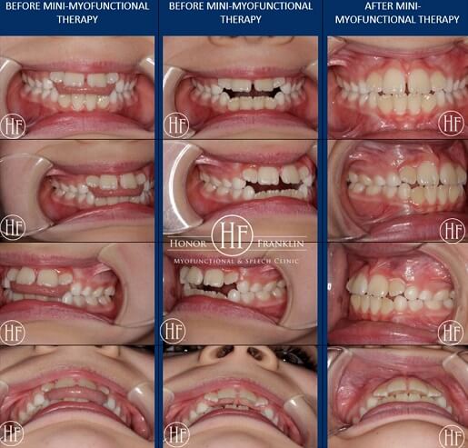 Myofunctional Therapy (Lip Competence) Gallery