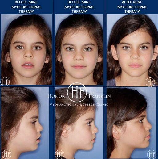 Myofunctional Therapy (Lip Competence) Gallery