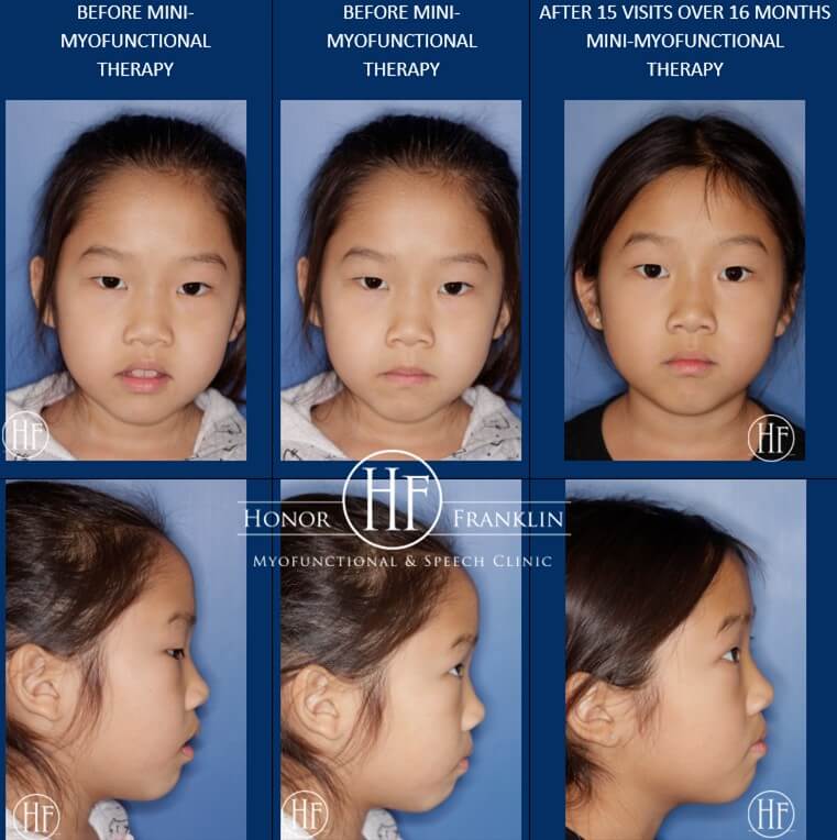 Myofunctional Therapy (Lip Competence) Gallery