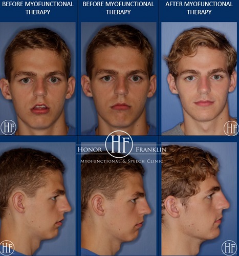 Formal Orofacial Myofunctional Therapy Gallery