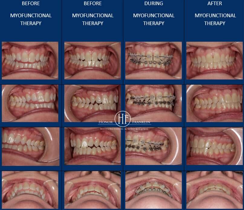 Formal Orofacial Myofunctional Therapy Gallery