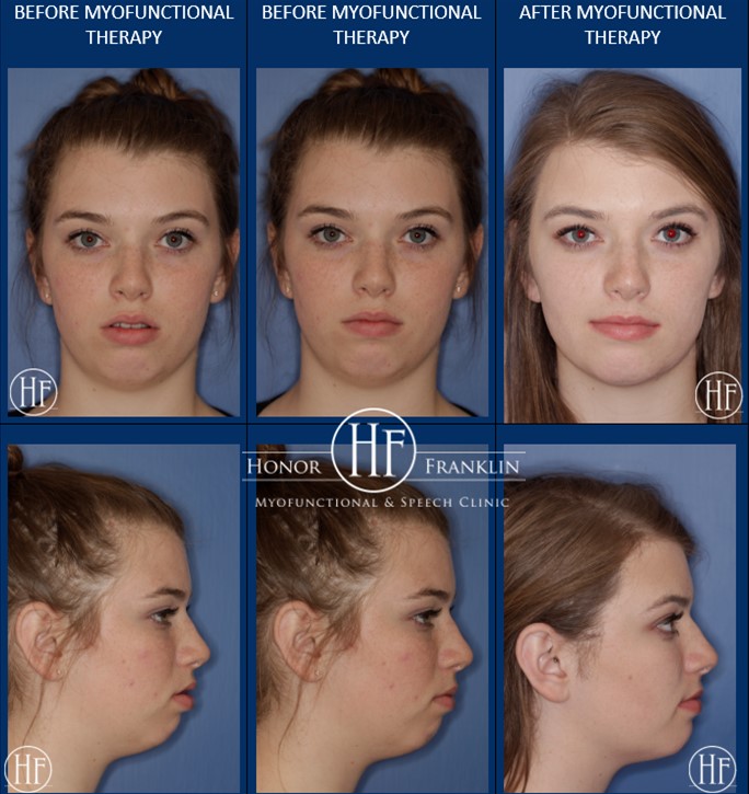 Formal Orofacial Myofunctional Therapy Gallery