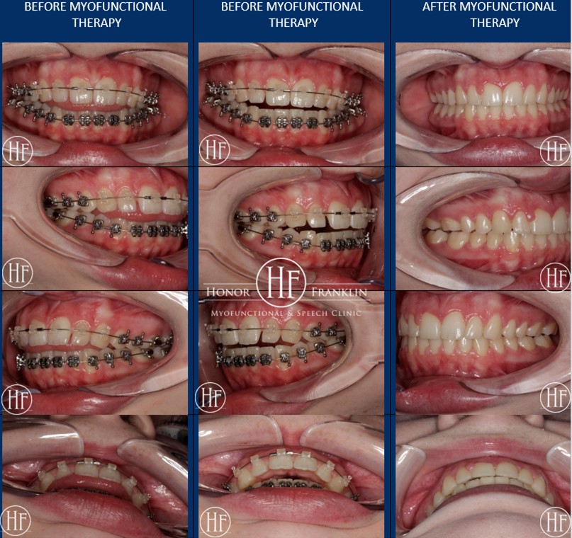 Formal Orofacial Myofunctional Therapy Gallery