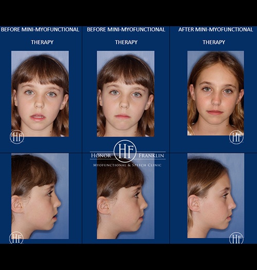 Mini – Orofacial Myofunctional Therapy (Lip Competence) Gallery