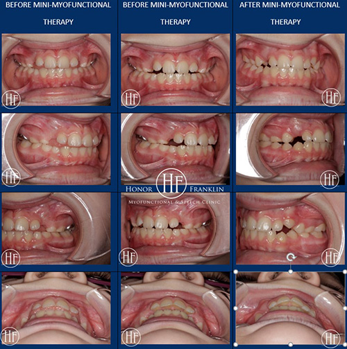 Mini – Orofacial Myofunctional Therapy (Lip Competence) Gallery