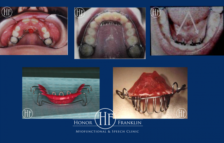 Do These Appliances Eliminate a Tongue Thrust? - Honor Franklin