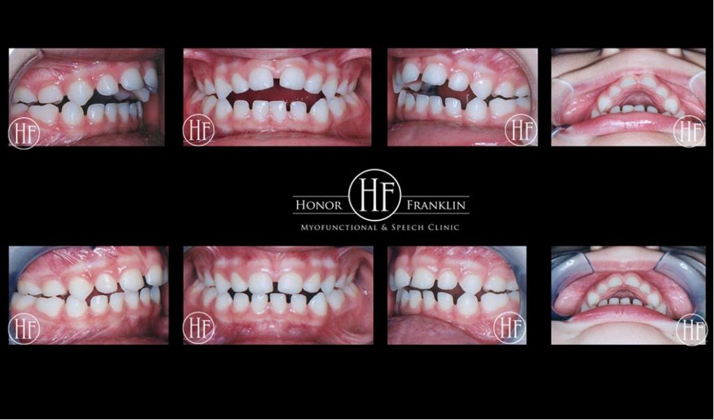 CAN THUMB SUCKING ALTER YOUR CHILD’S FACIAL APPEARANCE? - Honor Franklin