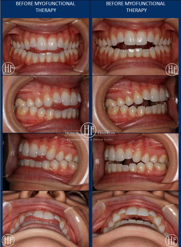 Am I Too Old for Tongue Thrust Therapy or Orofacial Myofunctional ...
