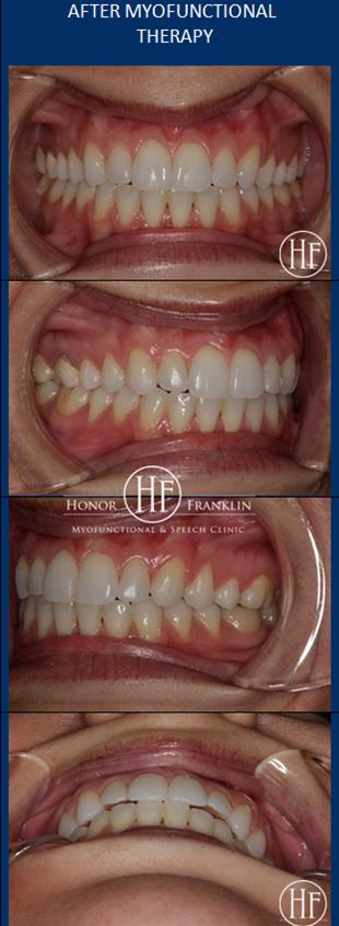 Am I Too Old for Tongue Thrust Therapy or Orofacial Myofunctional ...