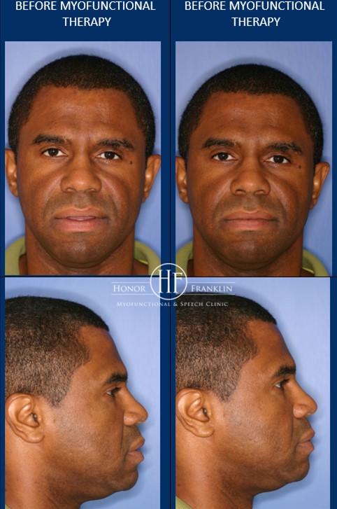 Is Orofacial Myofunctional Therapy (OMT) or Tongue Thrust Therapy Just ...