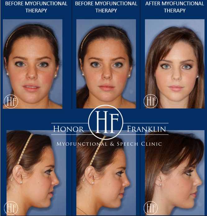 Why Are Photographs So Important for Orofacial Myofunctional Therapy ...