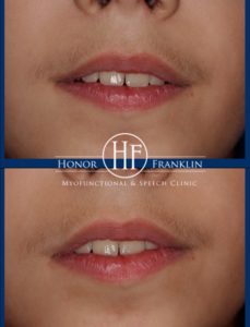 Achieving Lip Competence or Lip Closure - Honor Franklin